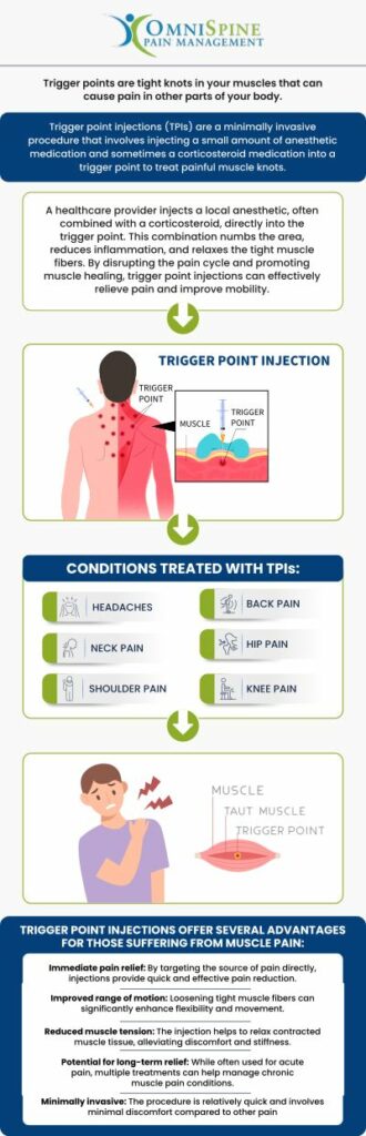 Everything You Need to Know About Trigger Point Injections